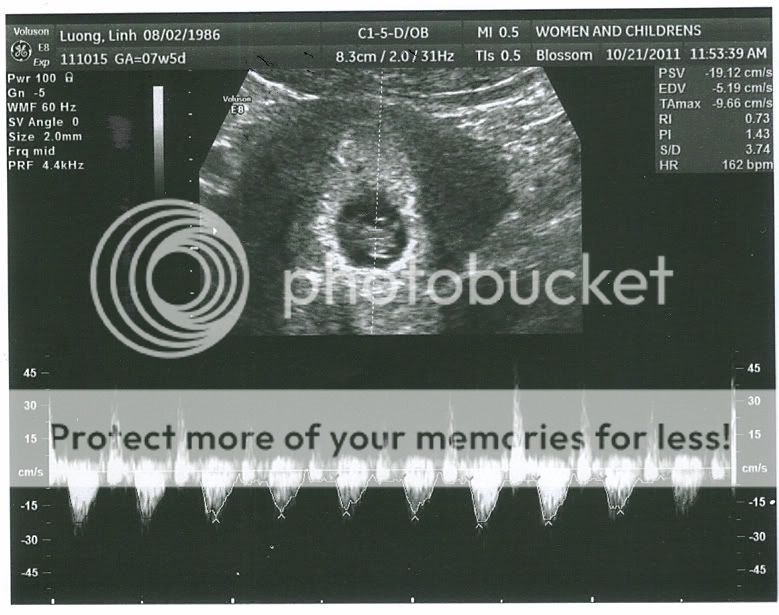 AL and JOJO, Please have a look at my 5w5d ultrasound! in Gender ...
