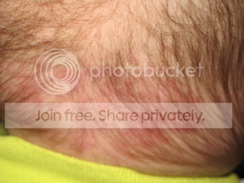 Stork Bite Back Of Head